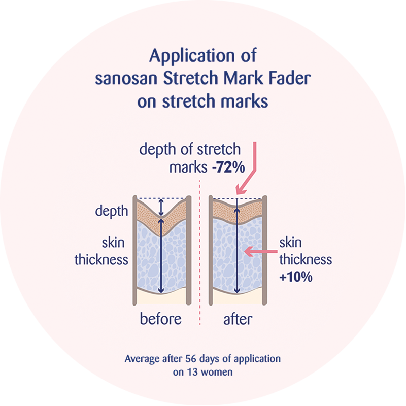 Sanosan Mama Stretch Mark Fader 75 Ml Sanosan Mama Stretch Mark Fader 75 Ml